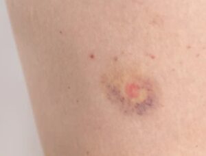 Common Paintball Injuries: Bruises, Welts, Wounds, and more - Paintballic